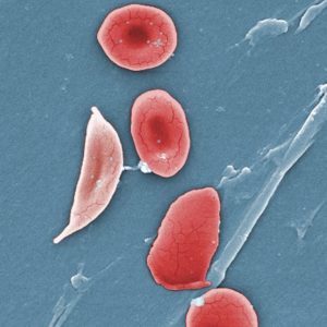 FDA Approves First Gene Therapies to Treat Patients with Sickle Cell ...